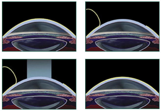 Epi-LASIK - Bergman Porretta Eye Center